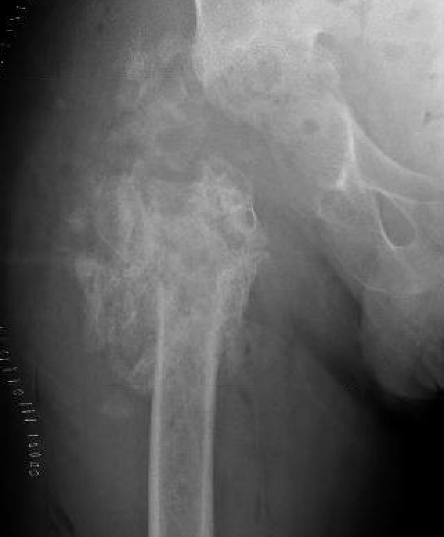 total hip arthroplasty | The Bone School